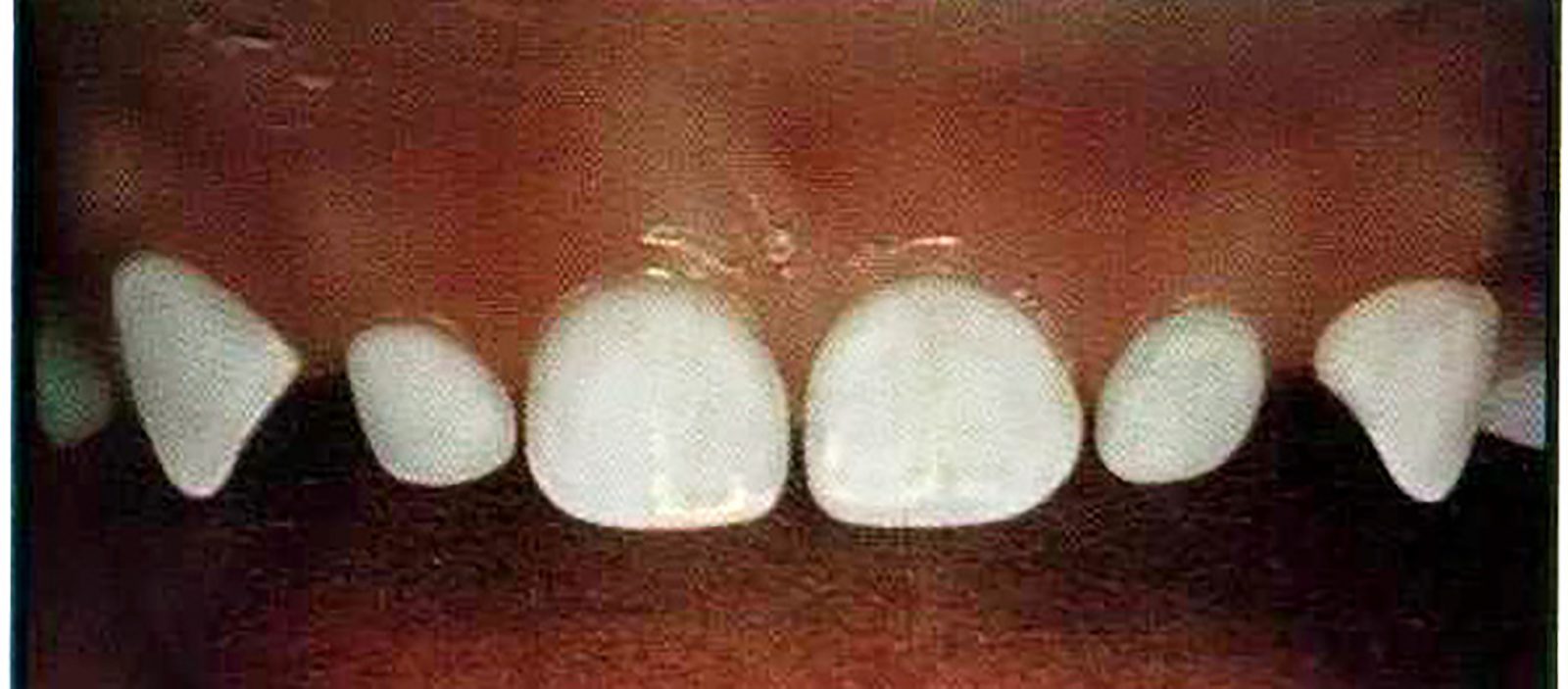 White Line On Gums